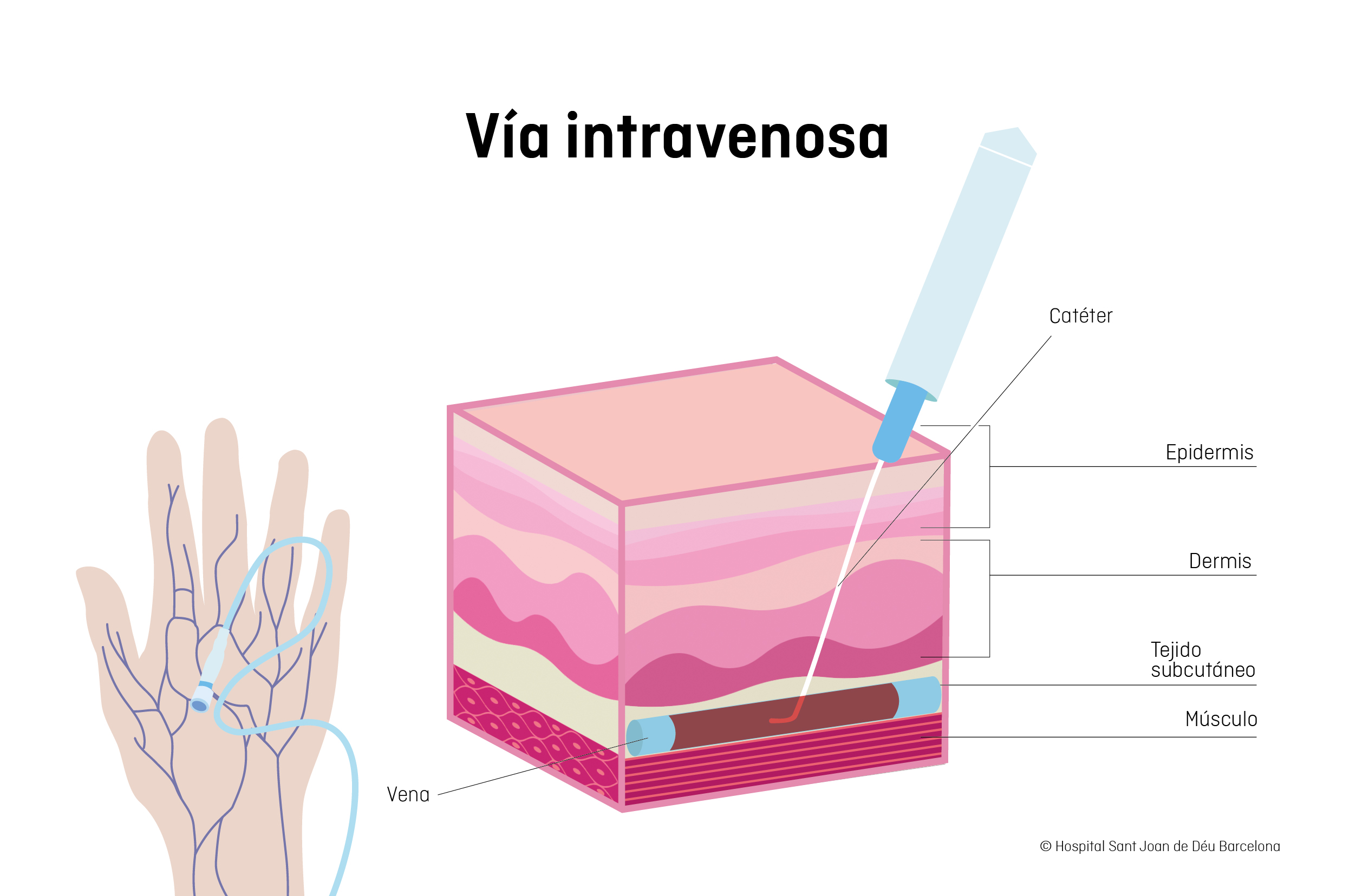 Vía intravenosa o endovenosa | Escola Salut SJD